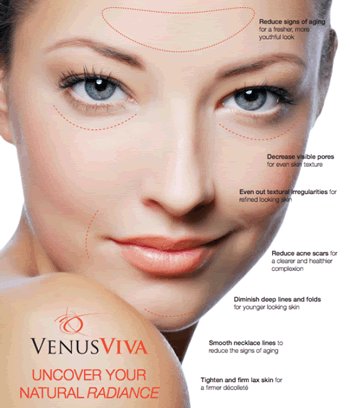 Venus Viva Skin Resurfacing – Vernon Smooth Effects